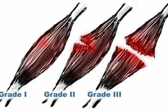 Hamstring Injury explained - Heal fast and strong! - Physio Prescription