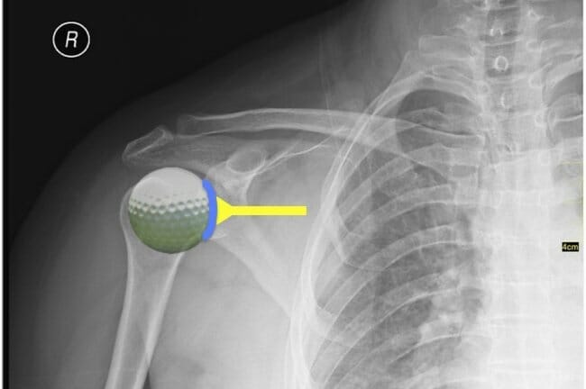 Shoulder pain Archives - PhysioPrescription