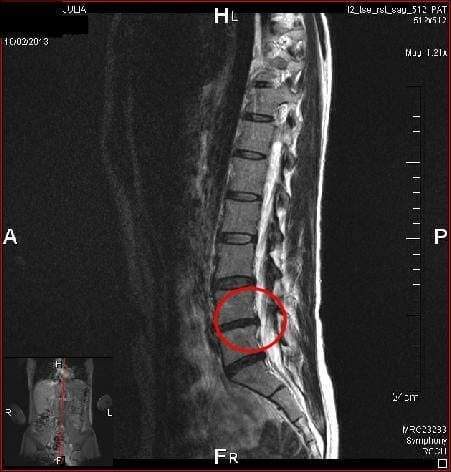 Spondylosis MRI - Physio Prescription