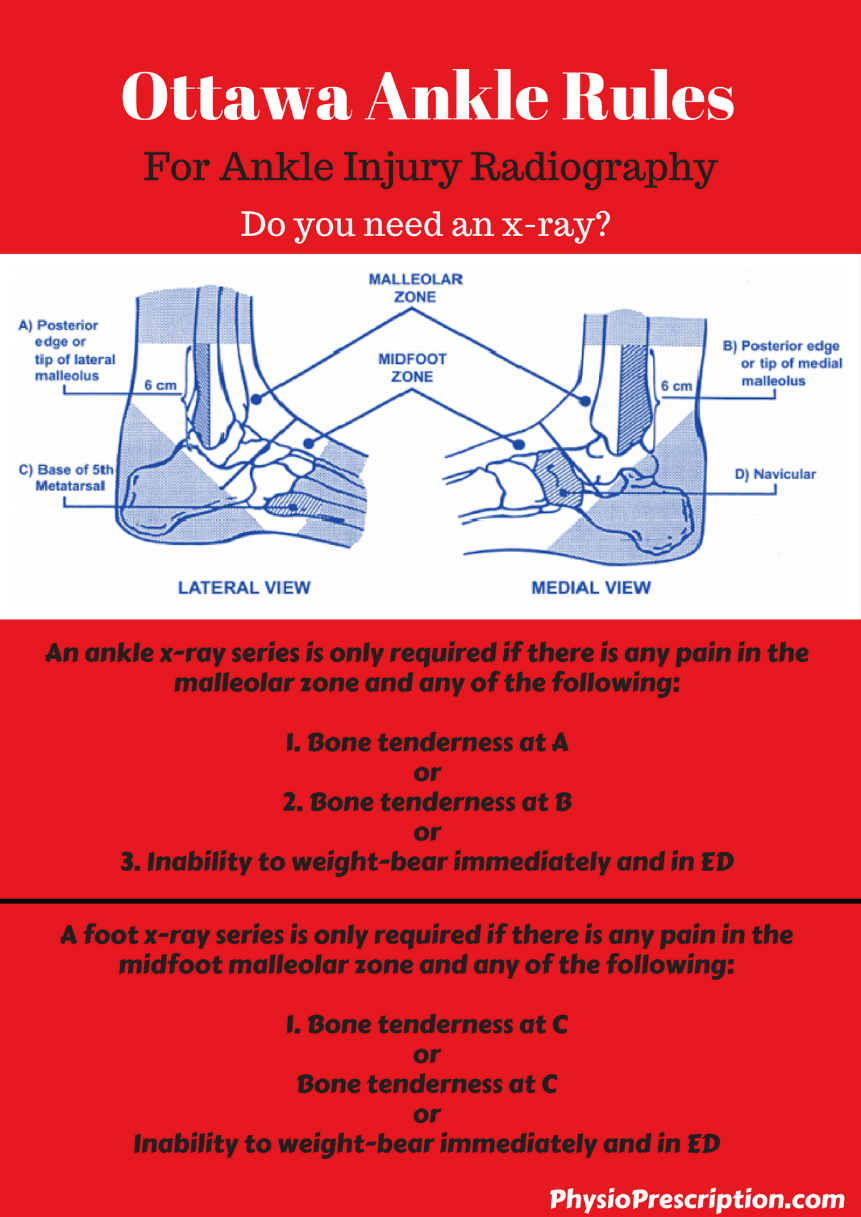 Ottawa ankle rules - Physio Prescription
